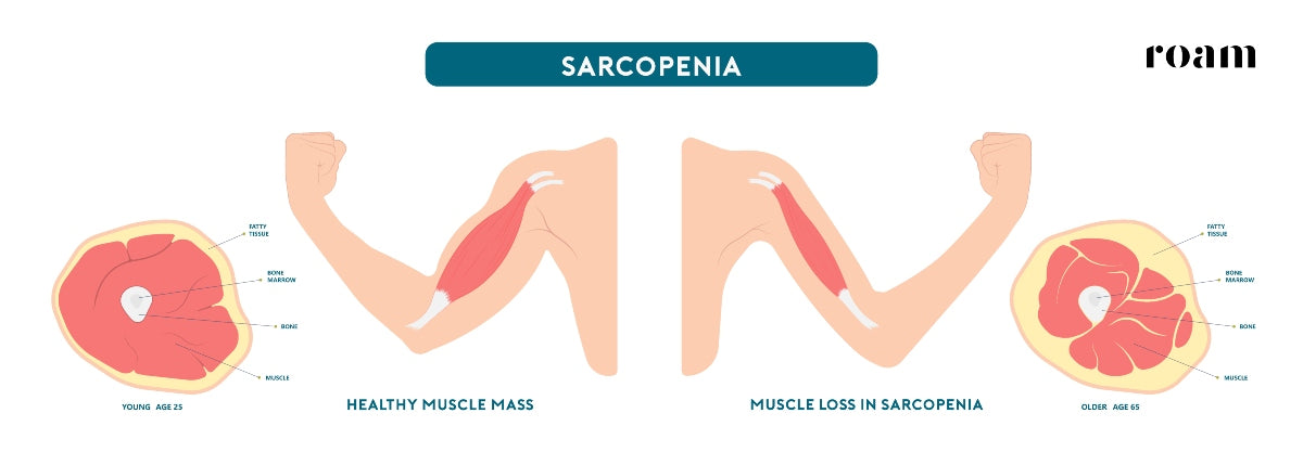 Understanding Sarcopenia: The Role of Protein Intake & Diet | Roam